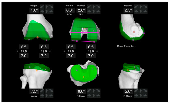 Functional Alignment Achieved a More Balanced Knee After Robotic Arm ...