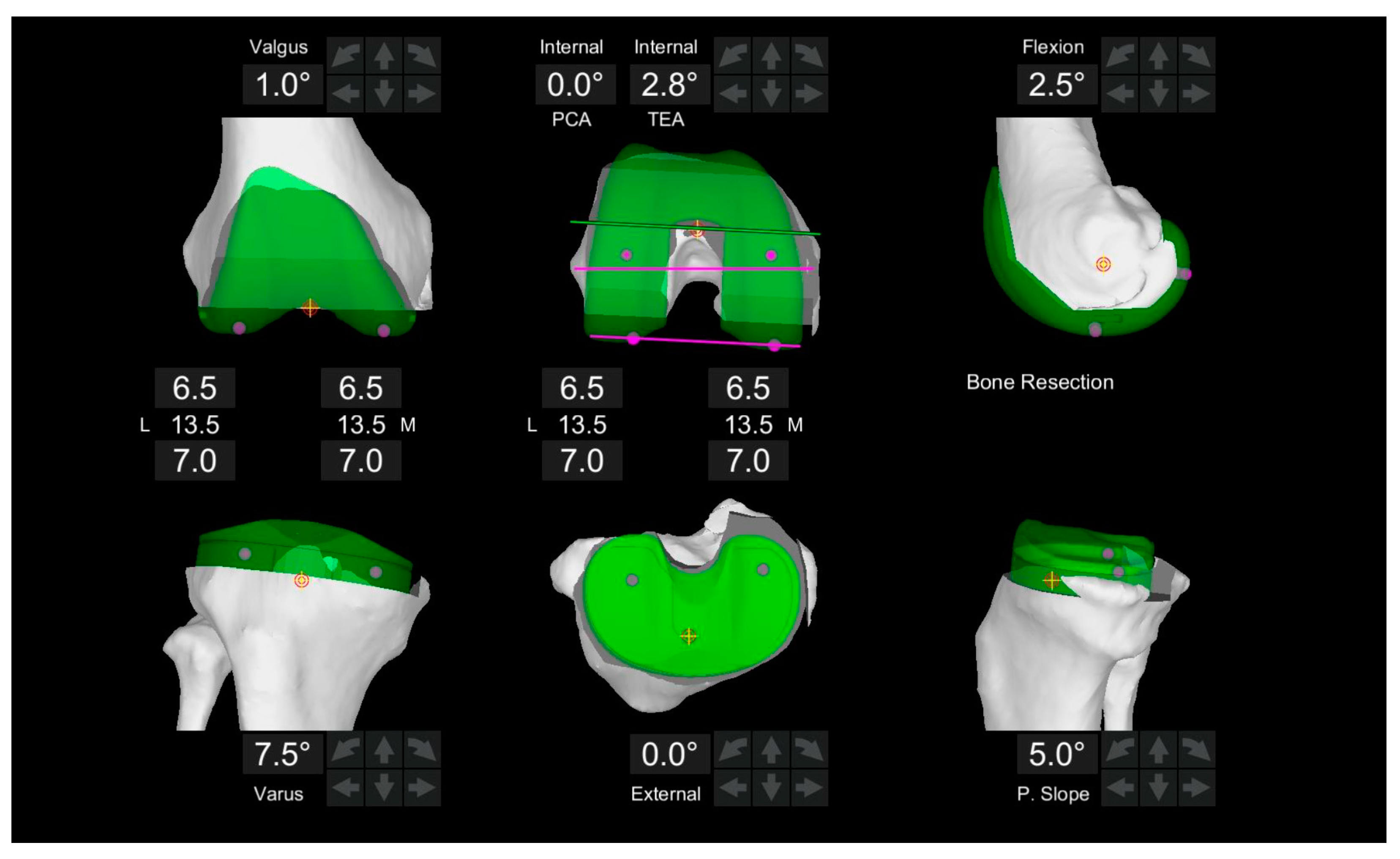 Functional Alignment Achieved a More Balanced Knee After Robotic Arm-Assisted Total Knee ...