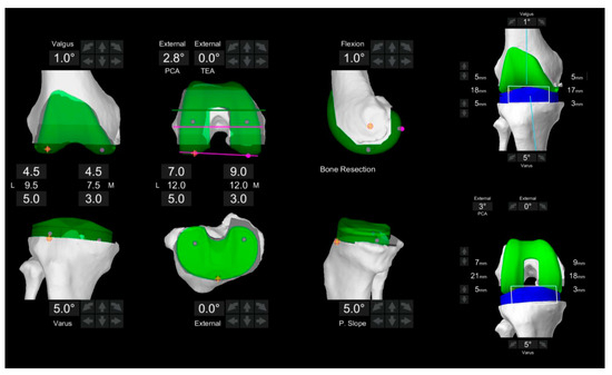 Functional Alignment Achieved a More Balanced Knee After Robotic Arm-Assisted Total Knee ...