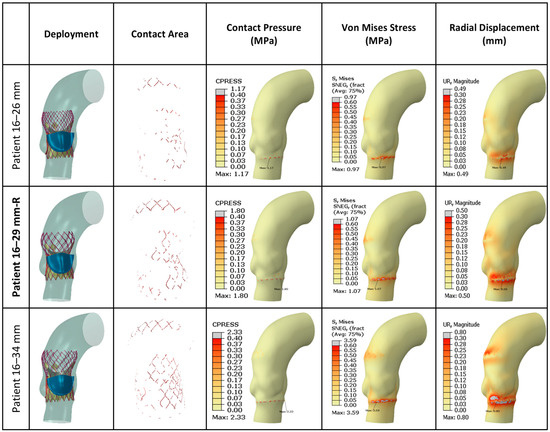 Finite Element Analysis of Evolut Transcatheter Heart Valves: Effects ...