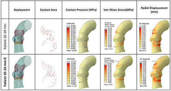 Finite Element Analysis of Evolut Transcatheter Heart Valves: Effects ...