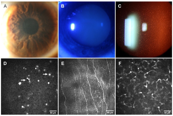 A Novel Pathogenic Variant in the KRT3 Gene in a Family with Meesmann ...