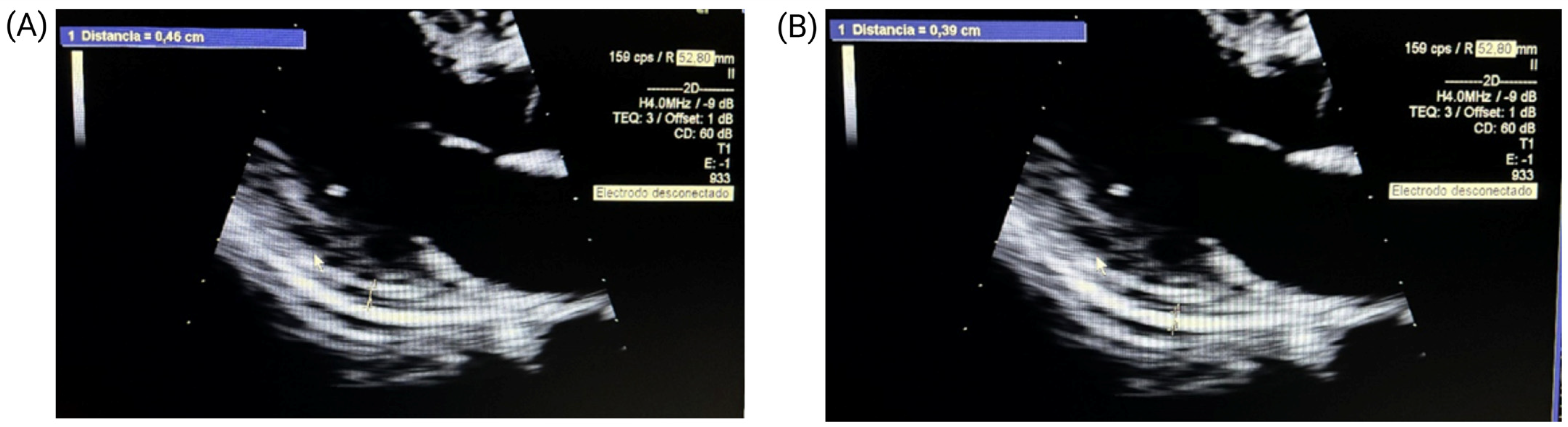 Myopericarditis and Pericardial Effusion as the Initial Presentation of ...