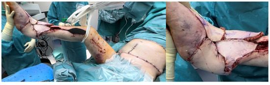 SCIP/SIEA and PAP: The New Workhorse Flaps in Soft Tissue ...
