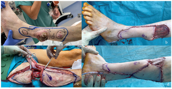 SCIP/SIEA and PAP: The New Workhorse Flaps in Soft Tissue ...