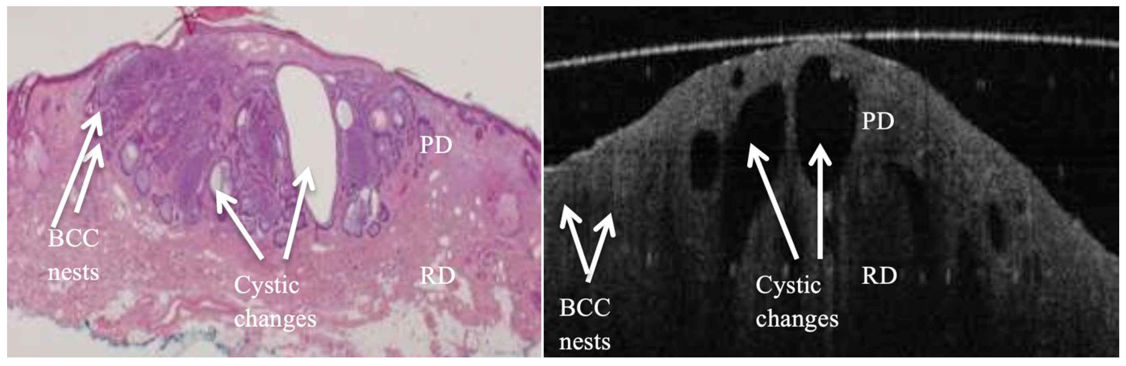 In Vivo Optical Coherence Tomography for the Detection, Subtyping, and ...