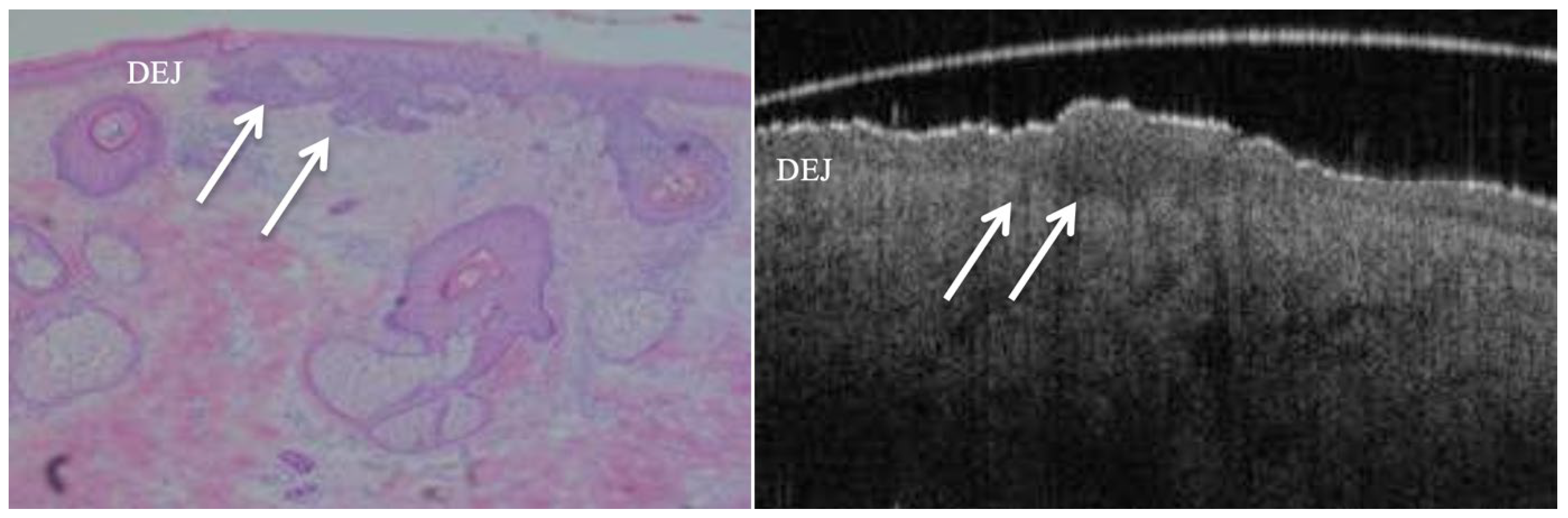 In Vivo Optical Coherence Tomography for the Detection, Subtyping, and ...