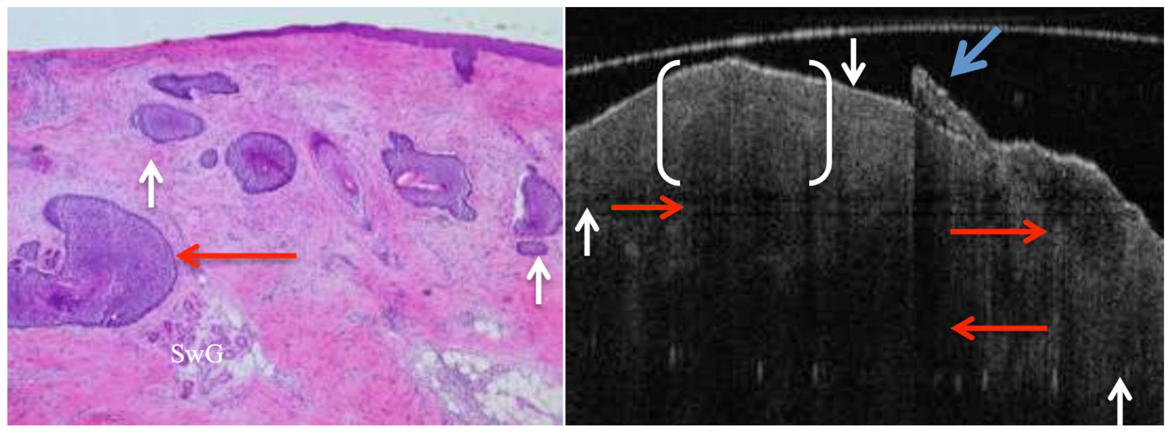 In Vivo Optical Coherence Tomography for the Detection, Subtyping, and ...