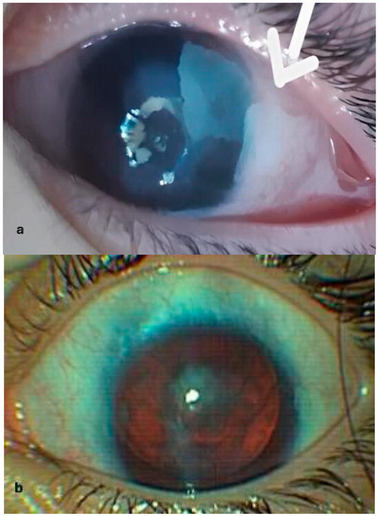 Bitot-like Spots and Congenital Aniridia: A Case Report