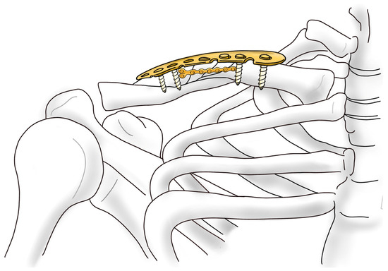 Intuitive and Minimally Invasive Surgical Technique for Comminuted Mid ...