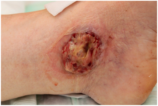 Paraneoplastic Dermatoses: A Clue for Underlying Malignancies