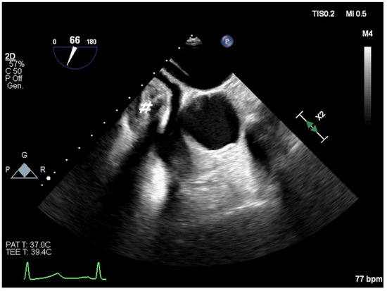 The Role of Trans-Oesophageal Echocardiography in the Interventional ...