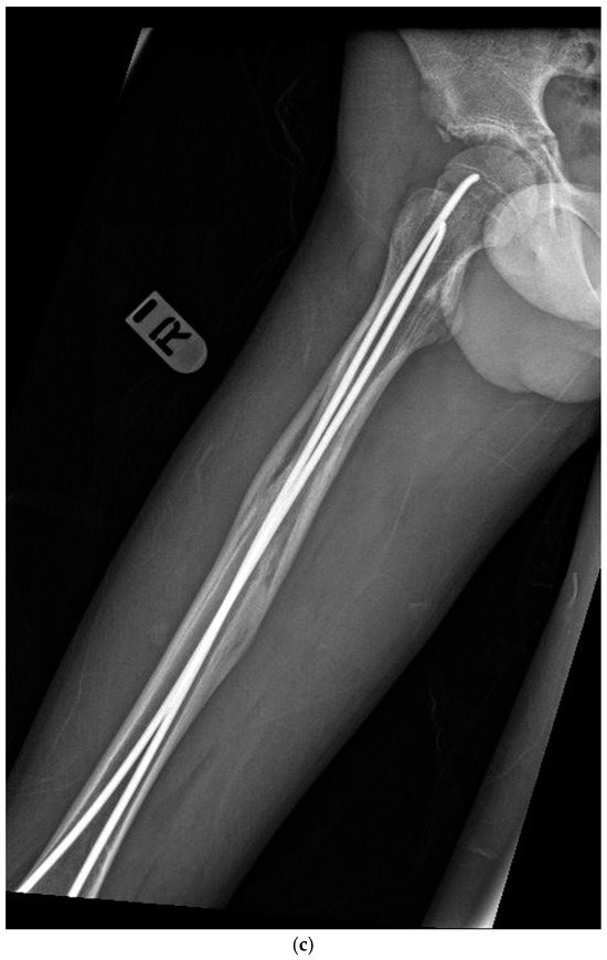 Enhancing Stability of Pediatric Femoral Fractures Treated with Elastic Nail Using an External ...