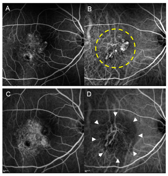 The Past, Present, and Future Perspective of Photodynamic Therapy for ...
