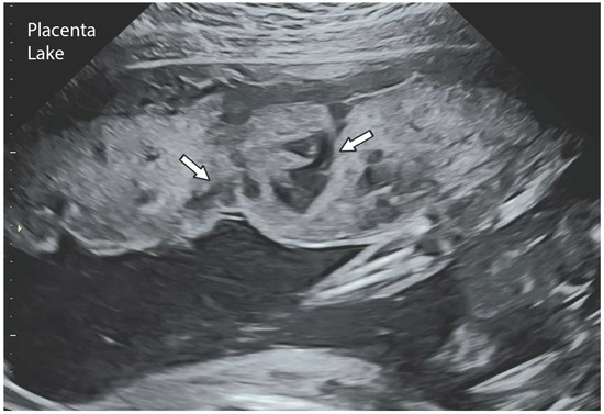 What Is the Significance of Placental Lakes in Pregnancy? A Historic Literature Review