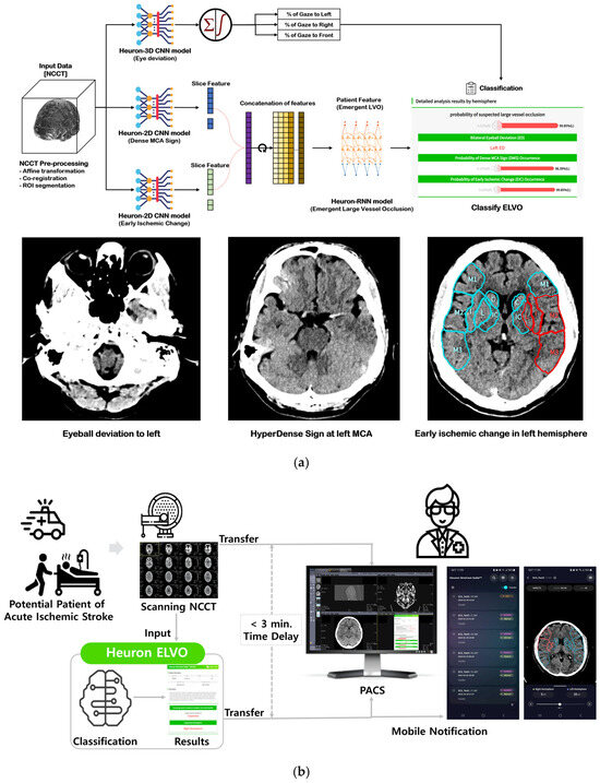 Non-Contrast Computed Tomography-Based Triage and Notification for Large Vessel Occlusion Stroke ...