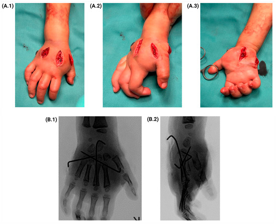 Acute Compartment Syndrome with Multiple Metacarpal Fractures in the ...