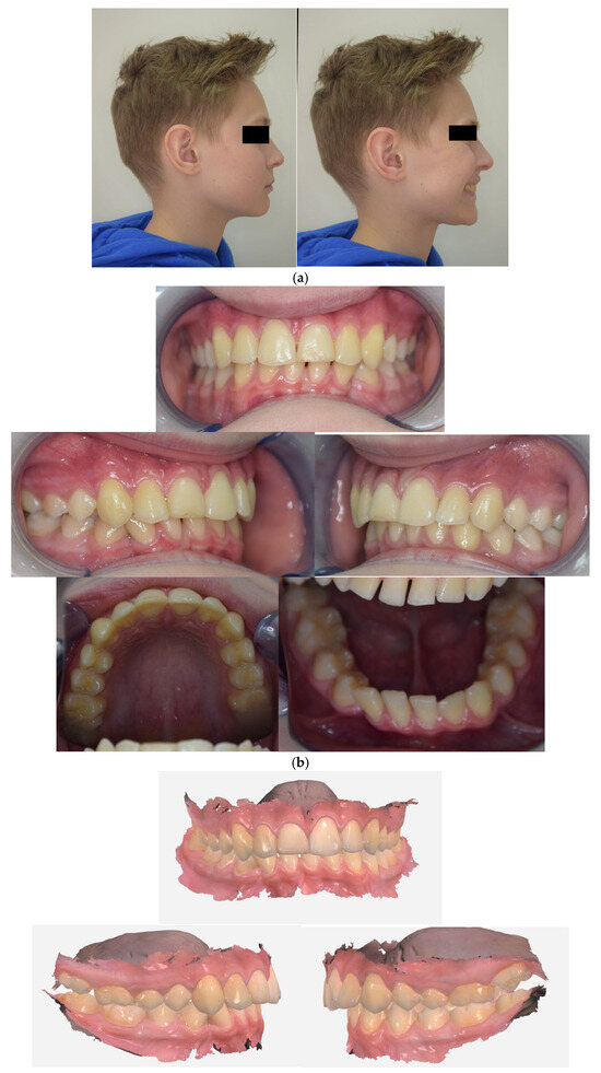 Orthodontic Treatment of a Transmigrating Impacted Lower Canine Using a ...