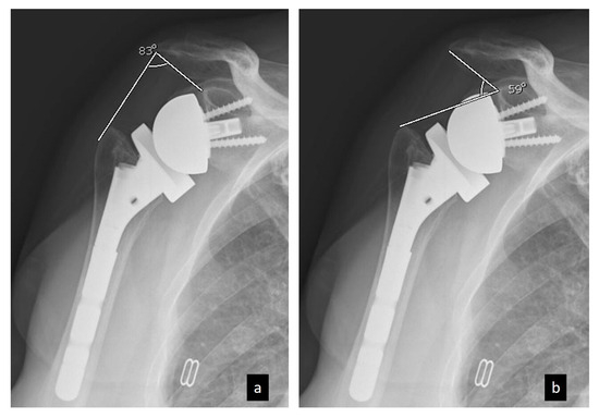 Lateralization and Distalization Shoulder Angles in Reverse Shoulder ...