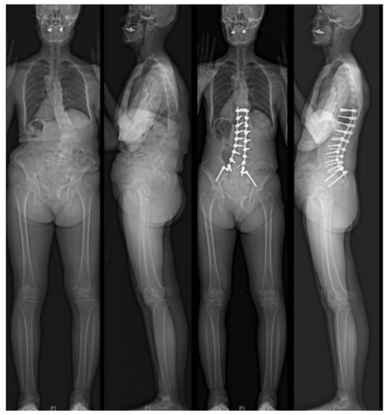 Anterior Versus Posterior Lumbar Interbody Fusion at L5-S1 in Hybrid ...