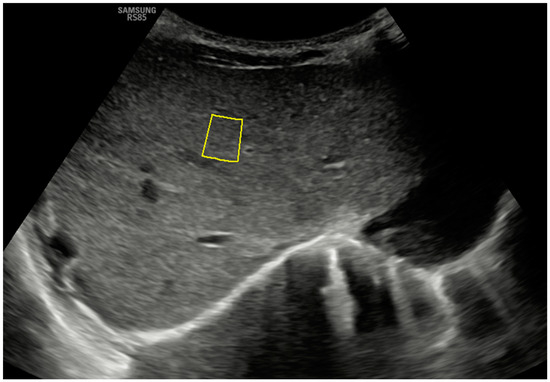 Technical Notes on Liver Elastography: A Guide for Use in Neonates in ...