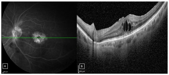 Radial Peripapillary Capillary Vessel Density as a New Biomarker in ...