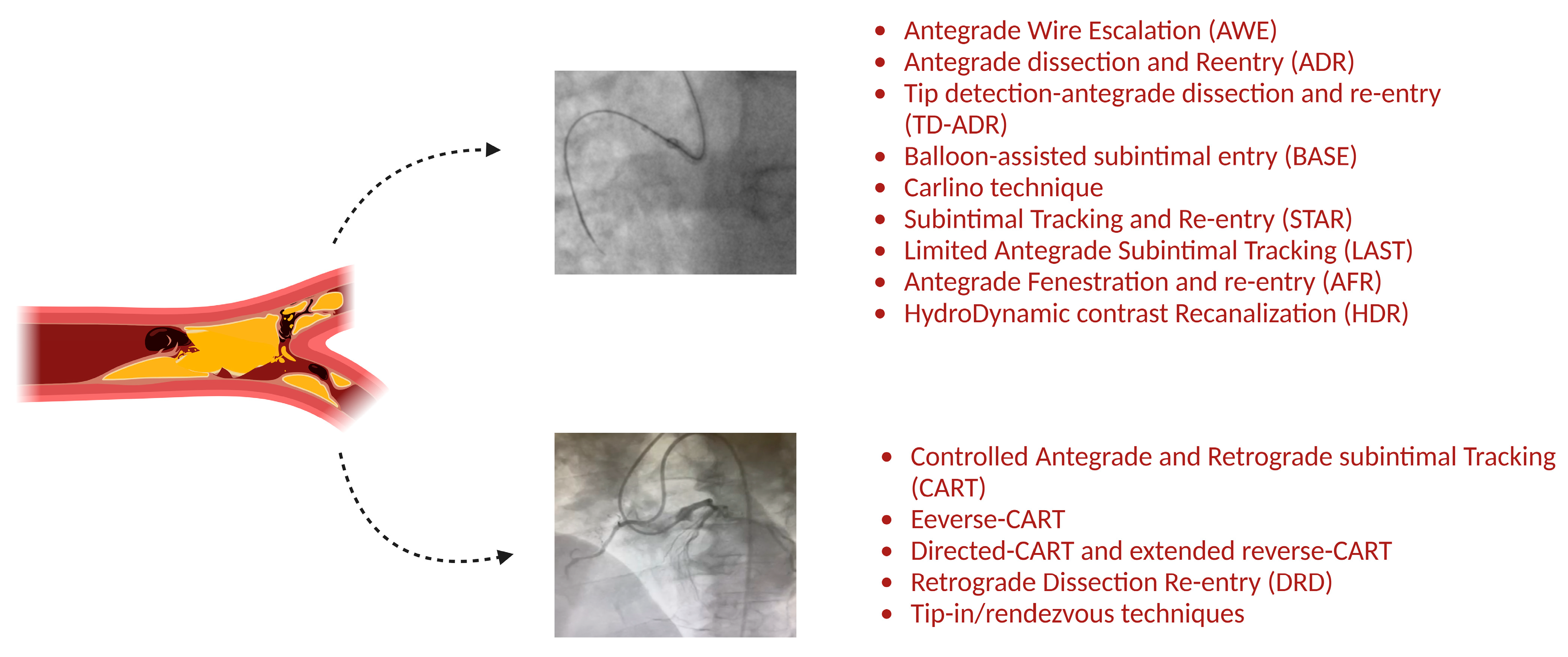 Recent Advances in Coronary Chronic Total Occlusions