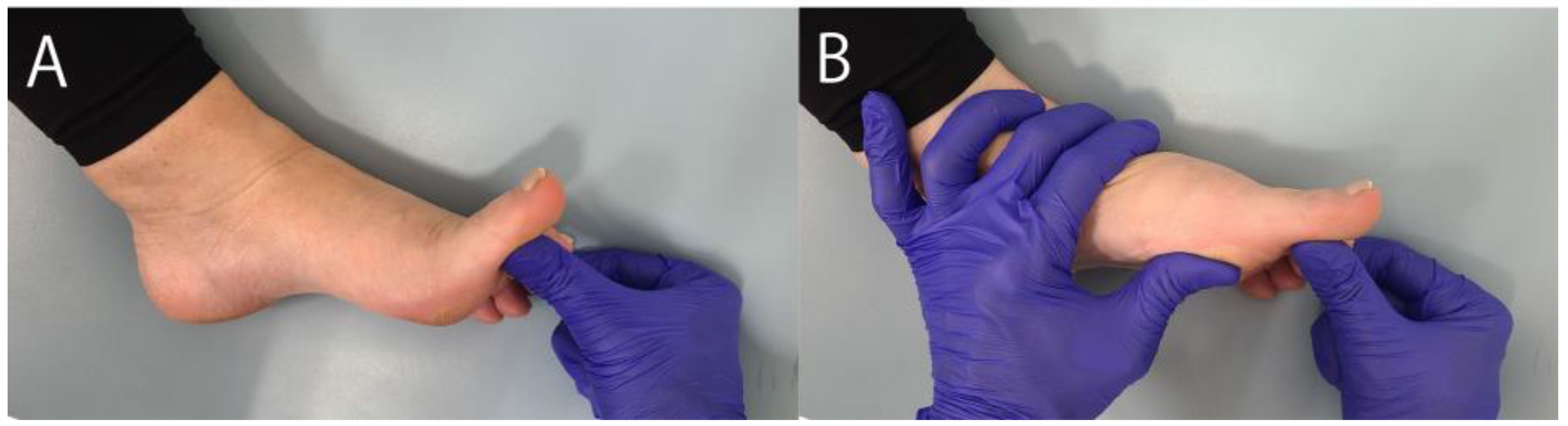 Joint-Preserving Surgeries for Hallux Rigidus Based on Etiology: A ...