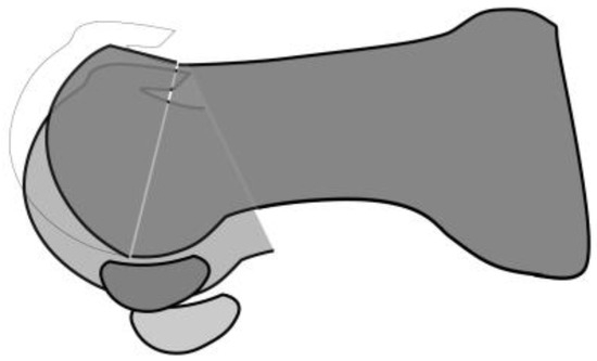 Joint-Preserving Surgeries for Hallux Rigidus Based on Etiology: A ...