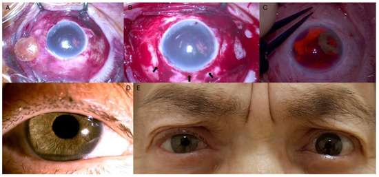 Novel Surgical Approach for Aphakia and Iridodialysis: Artificial Iris ...