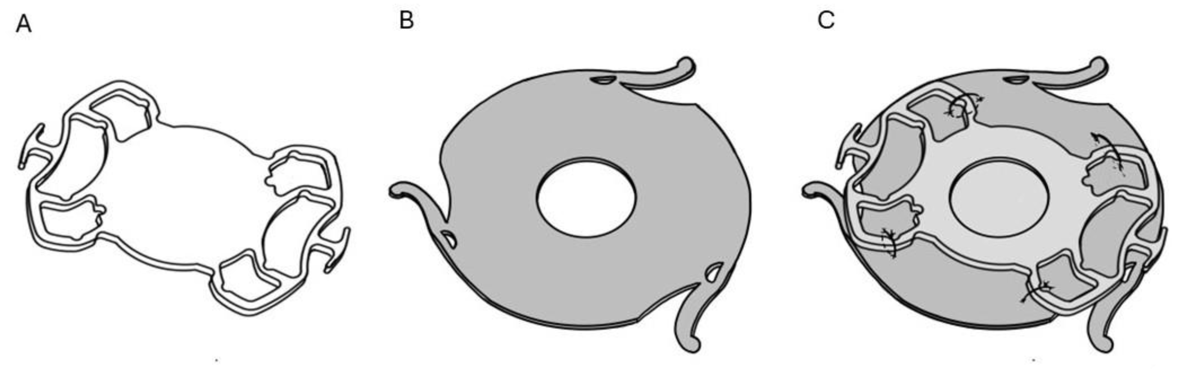 Novel Surgical Approach for Aphakia and Iridodialysis: Artificial Iris ...