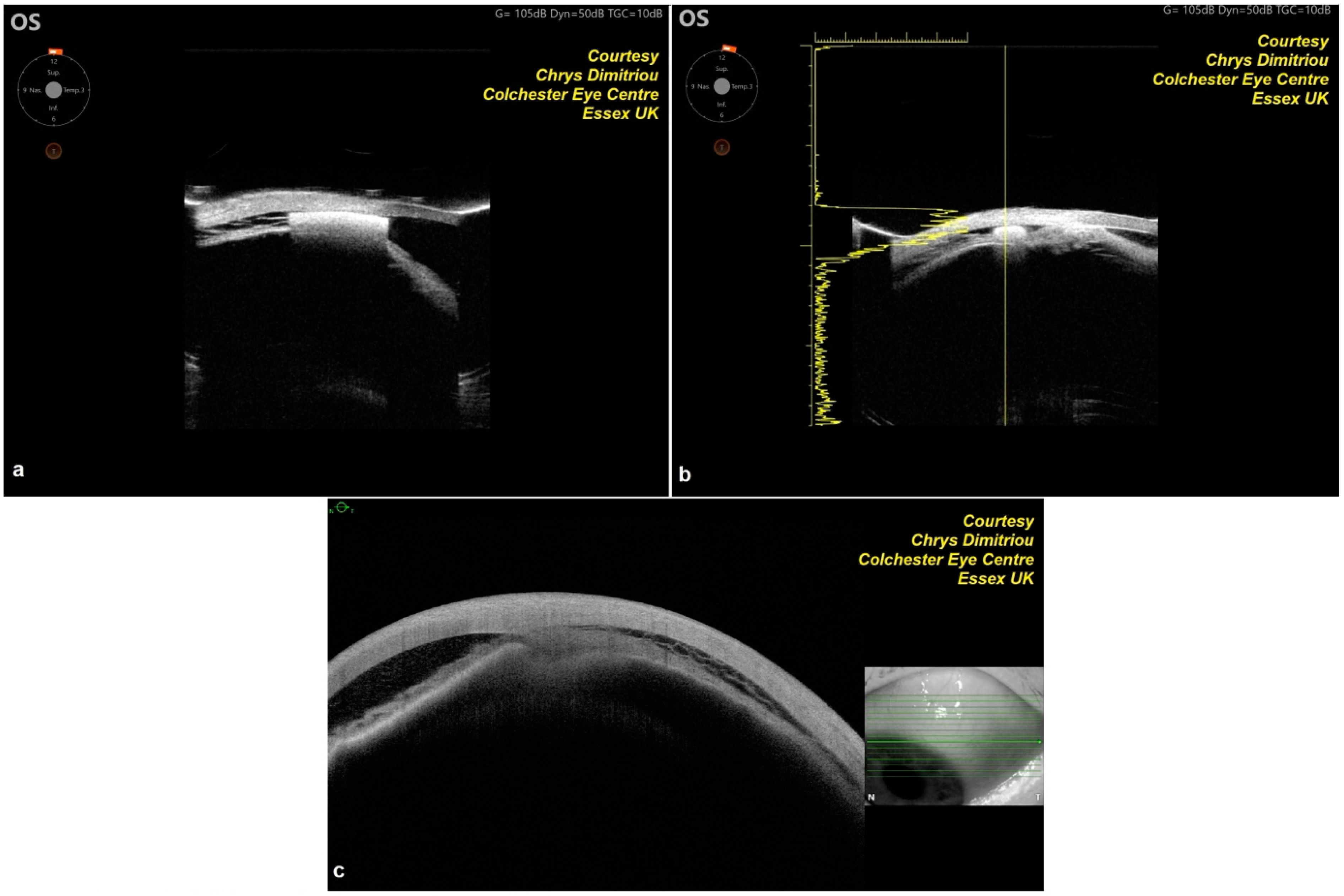Two-Year Data on the Efficacy and Safety of the MINIject Supraciliary ...