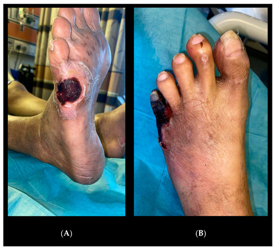 Limb Salvage in Patients with Concomitant Advanced Malignancy