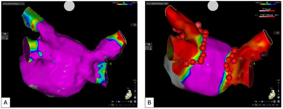 Catheter Ablation of Atrial Fibrillation: Technique and Future Perspectives