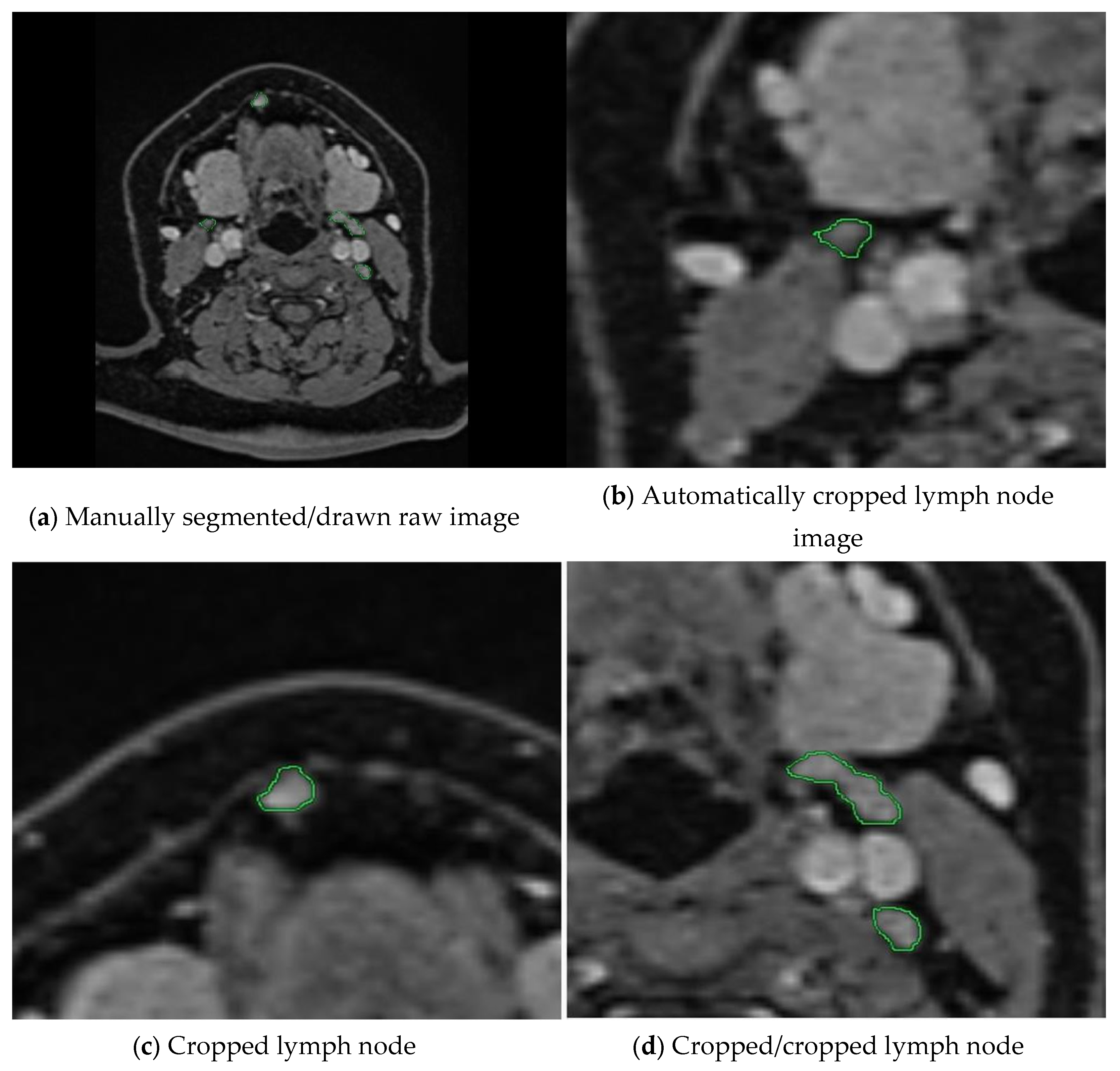 Novel Preprocessing-Based Sequence for Comparative MR Cervical Lymph Node Segmentation