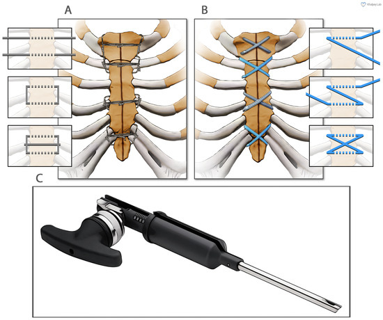 Implementation of Aseptically Processed Human Placental Membrane ...