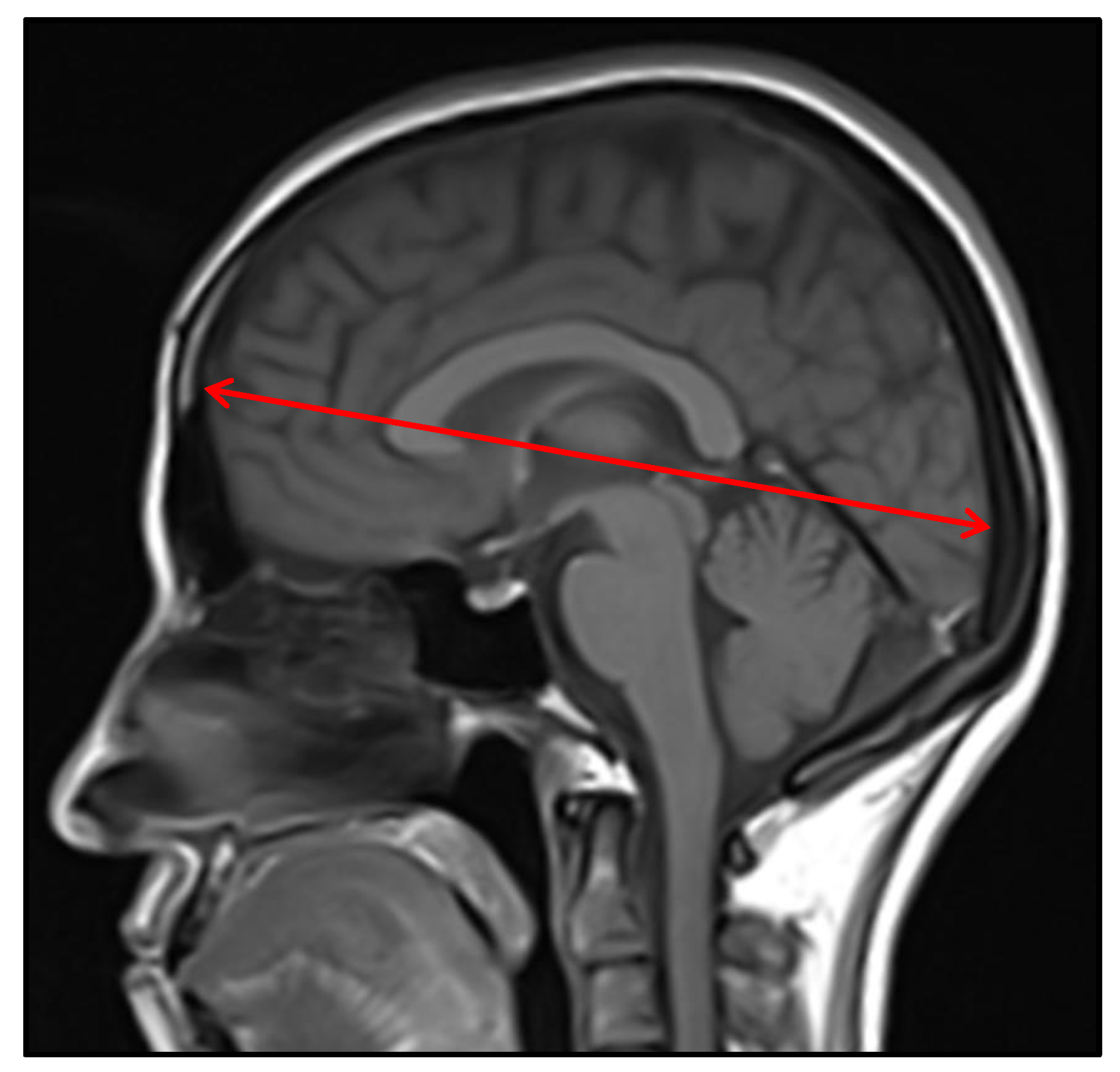Evaluation of Morphometric Findings of Corpus Callosum in Schizophrenia ...