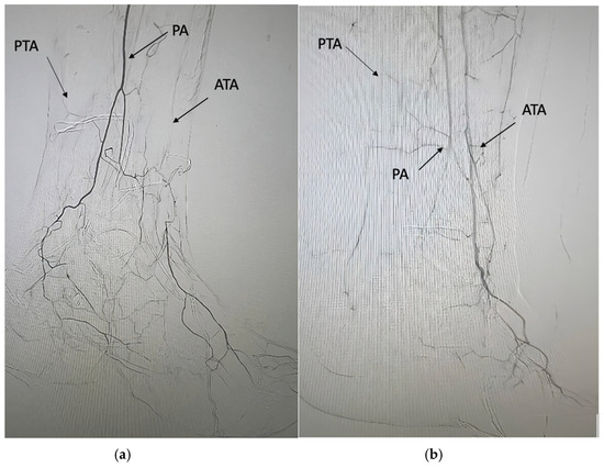 Peripheral Arterial Disease in Diabetic Foot: One Disease with Multiple ...