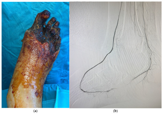 Peripheral Arterial Disease in Diabetic Foot: One Disease with Multiple ...