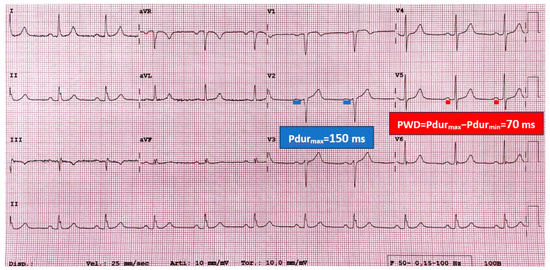 Predicting New-Onset Atrial Fibrillation in Hypertrophic Cardiomyopathy ...