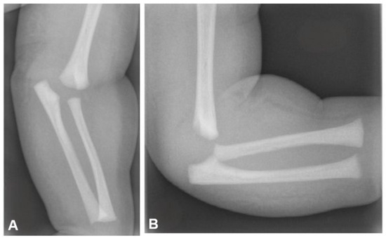 Comparative Outcomes of Treatment Strategies for Traumatic Distal ...