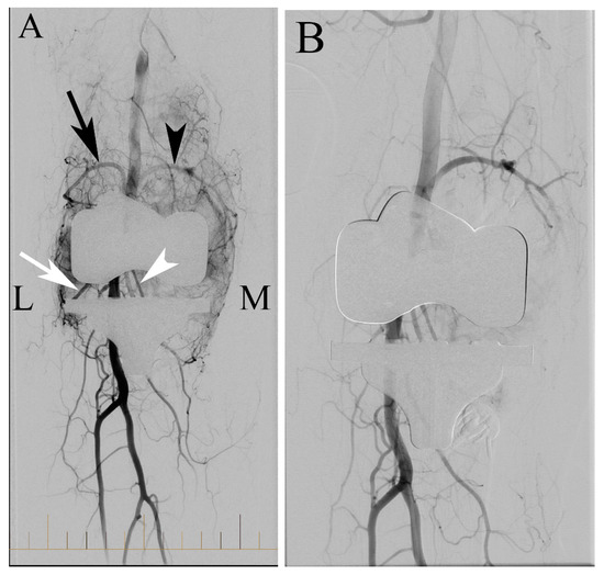 Genicular Artery Embolization: A Technical Review of Anatomy ...