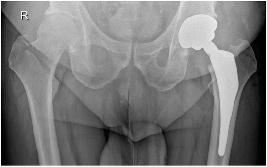 High Accuracy of Restoration of the Individual Hip Anatomy Using Custom ...