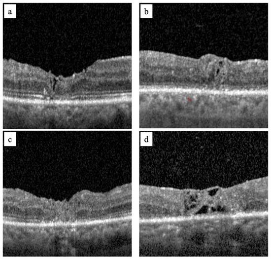 Combined Surgically Induced Macular Detachment and Autologous Internal ...