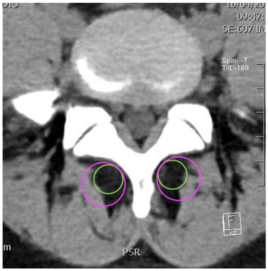 Lumbar Muscle Fatty Infiltration and Atrophy in Patients with Low Back ...