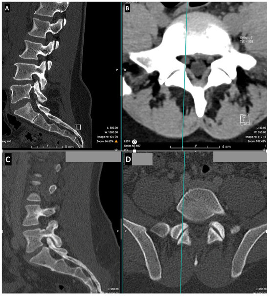 Lumbar Muscle Fatty Infiltration and Atrophy in Patients with Low Back ...