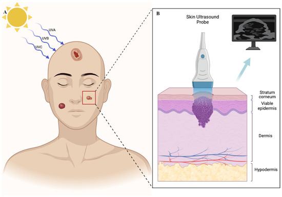 Advances in Skin Ultrasonography for Malignant and Benign Tumors of the ...