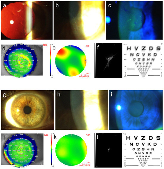 Enhancing Visual Quality: The Impact of Alcohol-Assisted Delamination ...