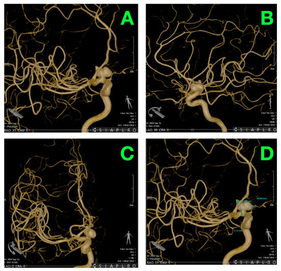Complex Anatomy Advanced Techniques Microsurgical Clipping Of A