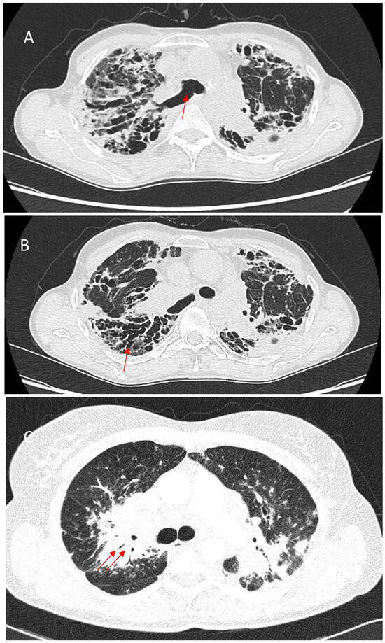 Fibrotic Pulmonary Sarcoidosis—From Pathogenesis to Management